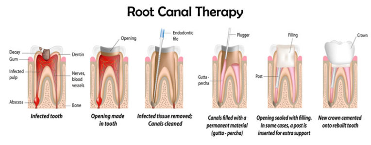 What is Root Canal Treatment - Demonstration - Preferred Dental Care